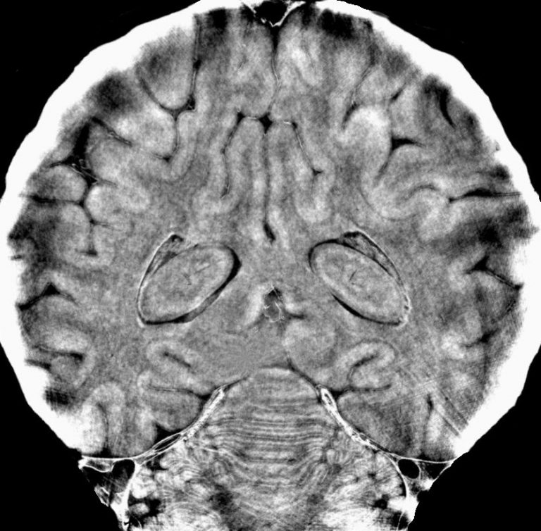 Linda Croton - X-ray Phase Contrast CT of a Neonatal Sheep Brain ...